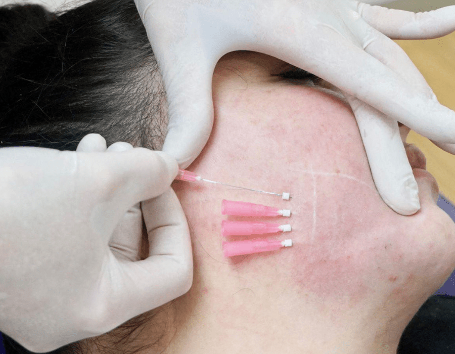 Matrix PDO Mono Threads Treatment in Melbourne CBD | Australian Laser ...