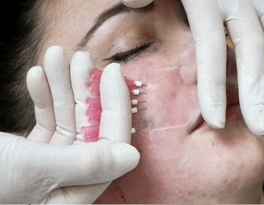 Matrix PDO Mono Threads Treatment in Melbourne CBD | Australian Laser ...