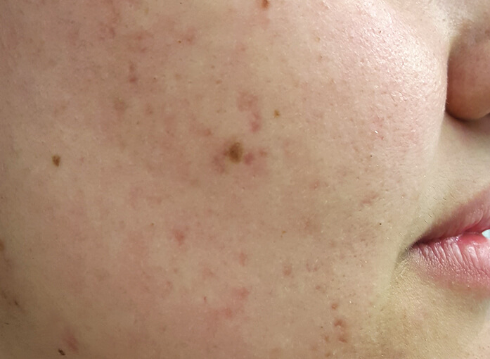 Skin Peeling on Face, Chemical Peels Melbourne | Lactic Acid Peel