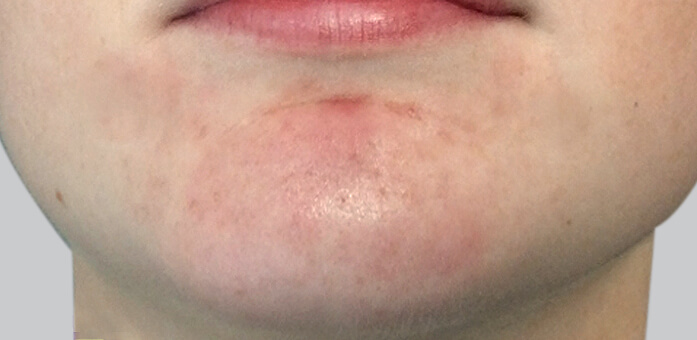 Skin Peeling on Face, Chemical Peels Melbourne | Lactic Acid Peel