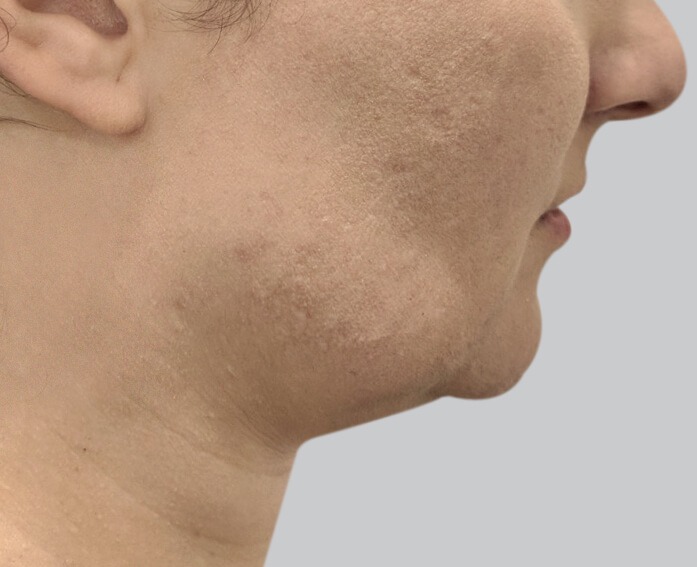 Double Chin Removal, Injections & Treatment | Australian Laser & Skin ...