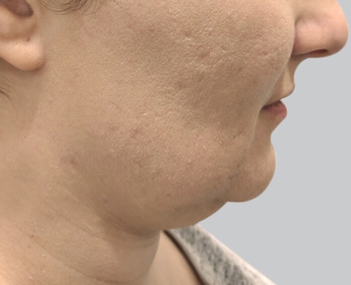 Double Chin Removal, Injections & Treatment | Australian Laser & Skin ...