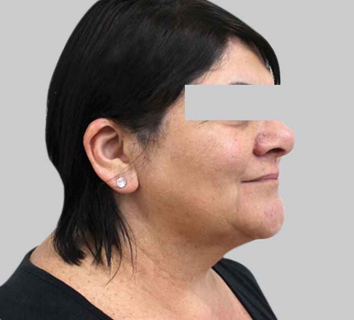 Double Chin Removal, Injections & Treatment | Australian Laser & Skin ...