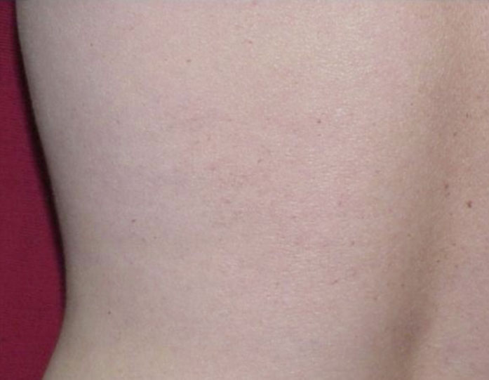 LED Light Therapy | Australian Laser & Skin