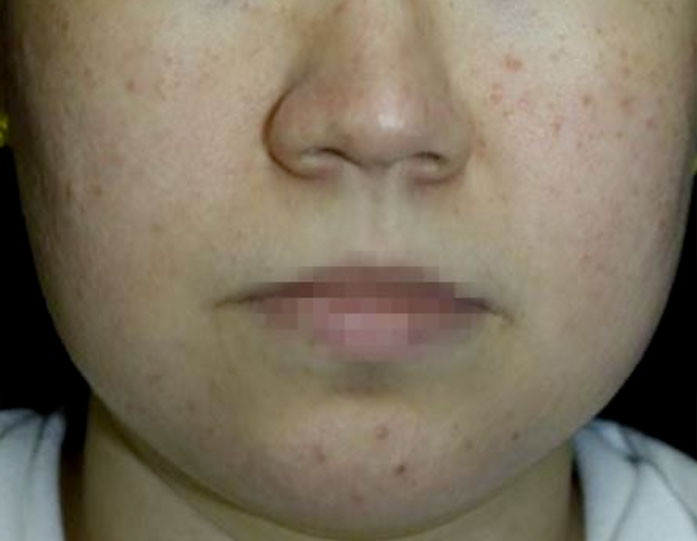 LED Light Therapy | Australian Laser & Skin